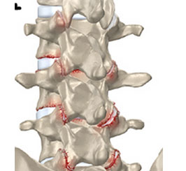 Arthrose Lombaire A 30 Ans _ Arthrose Lombaire Exercices – XVFPIK